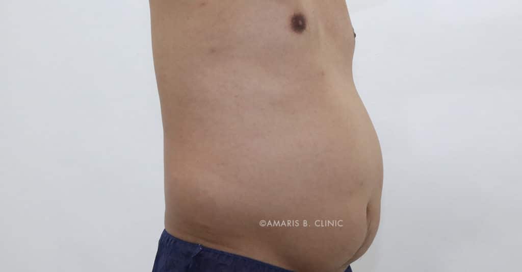 Side Effect of Pseudogynecomastia Treatment from Fat Freezing ...